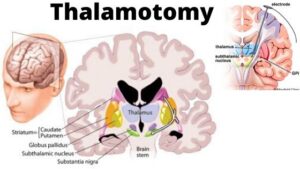 Medical Definition of Thalamotomy | Neurological Surgery